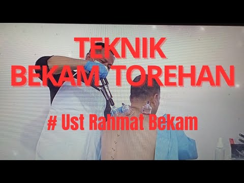 Teknik Bekam Torehan bersama Ustadz Rahmat Bekam Sukabumi - YouTube
