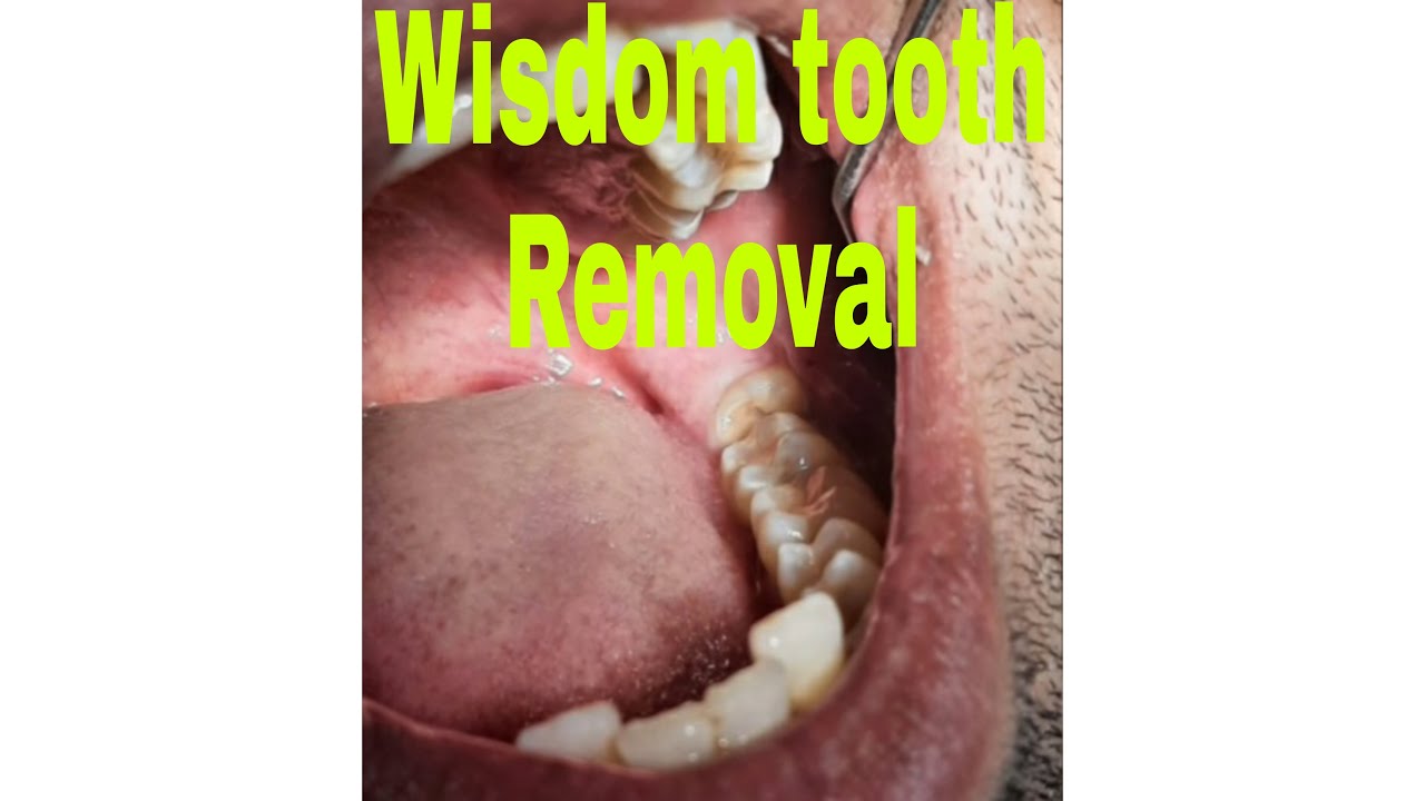 Wisdom tooth Removal | horizontal impaction | - YouTube