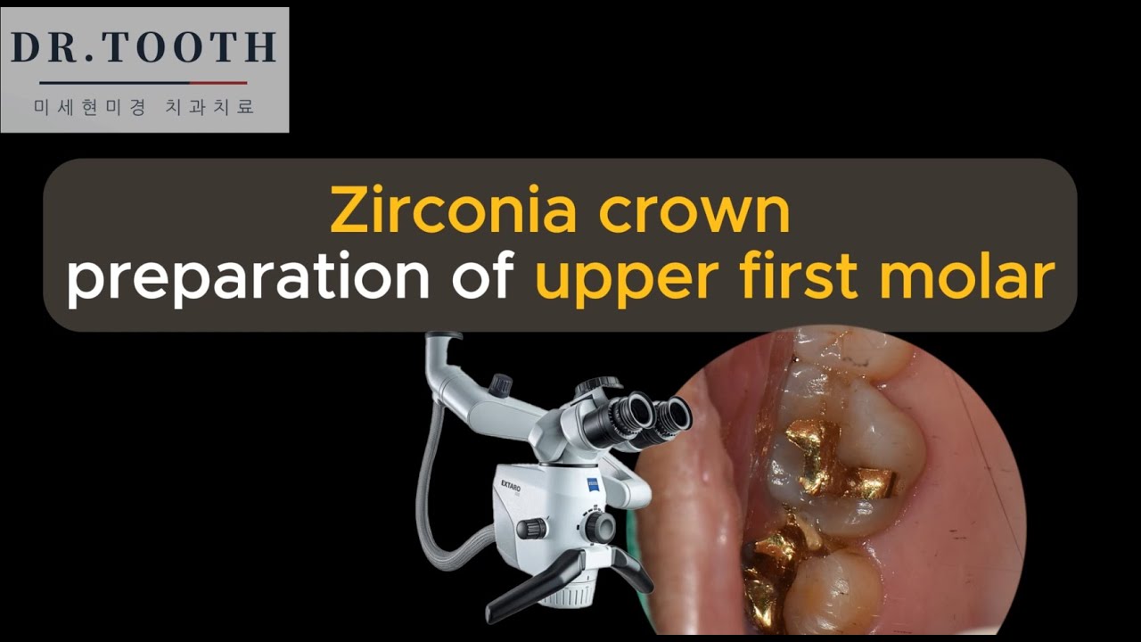 Zirconia crown preparation of upper first molar (#16) under microscope ...