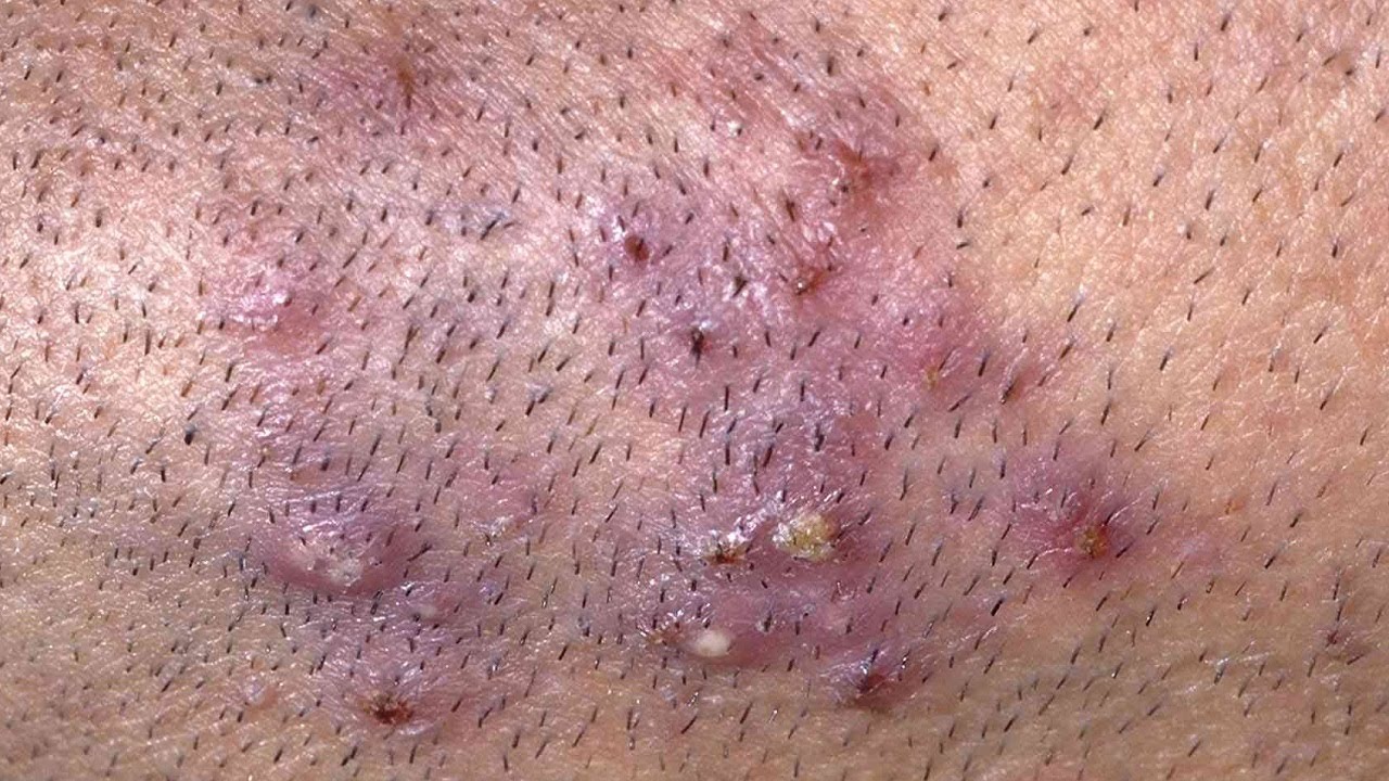 how to get rid of ingrown hairs on neck from shaving - YouTube