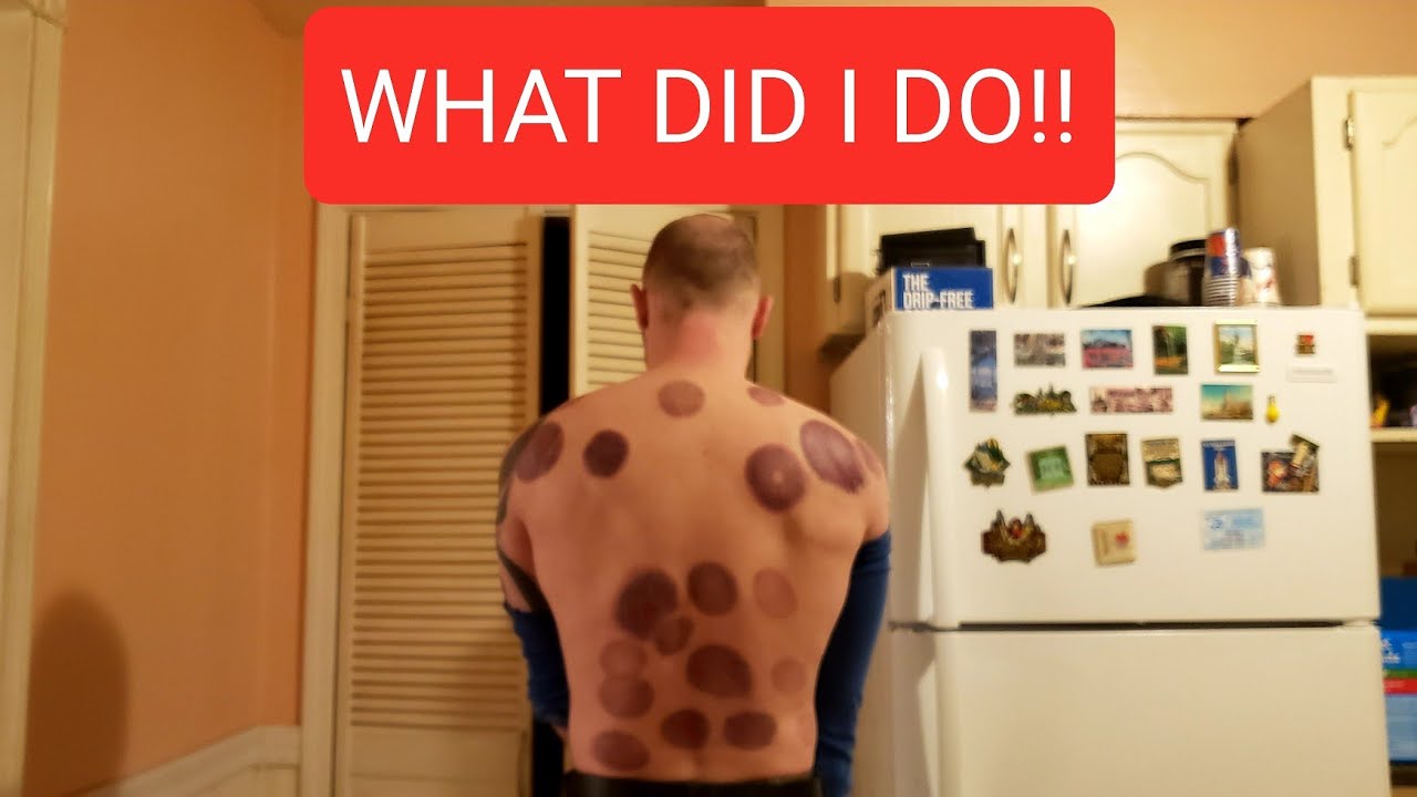 Cupping therapy and how it works - YouTube
