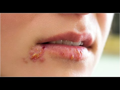 Shingles Pregnancy, What Are The Symptoms Of Shingles, Shingles Is It ...