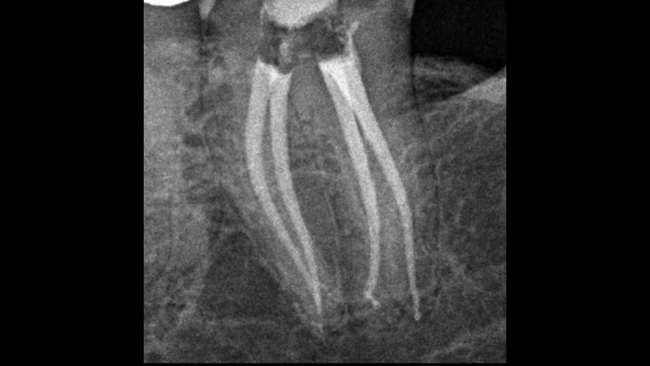 90 Day Dental Day 41- Massimo Giovarruscio - Locating MB2 - YouTube