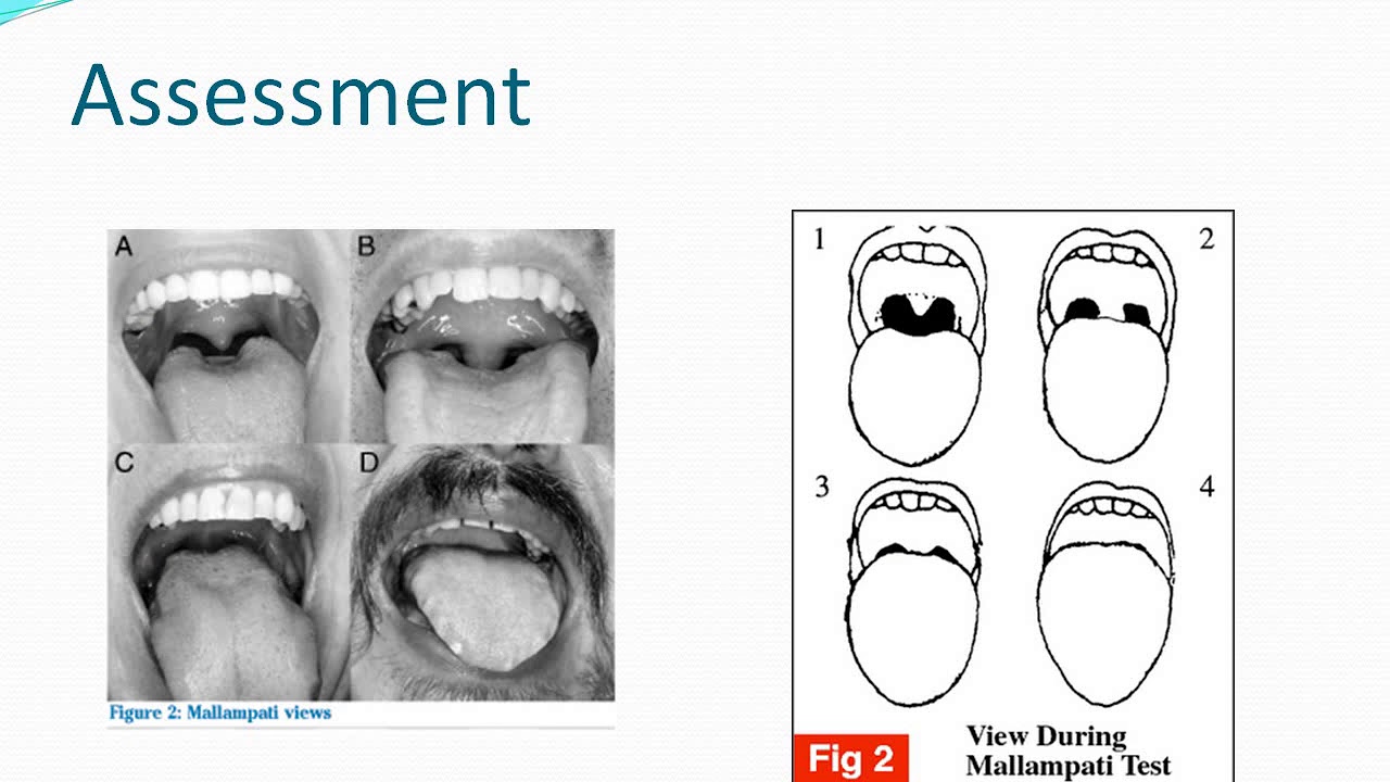 Airway Management - YouTube