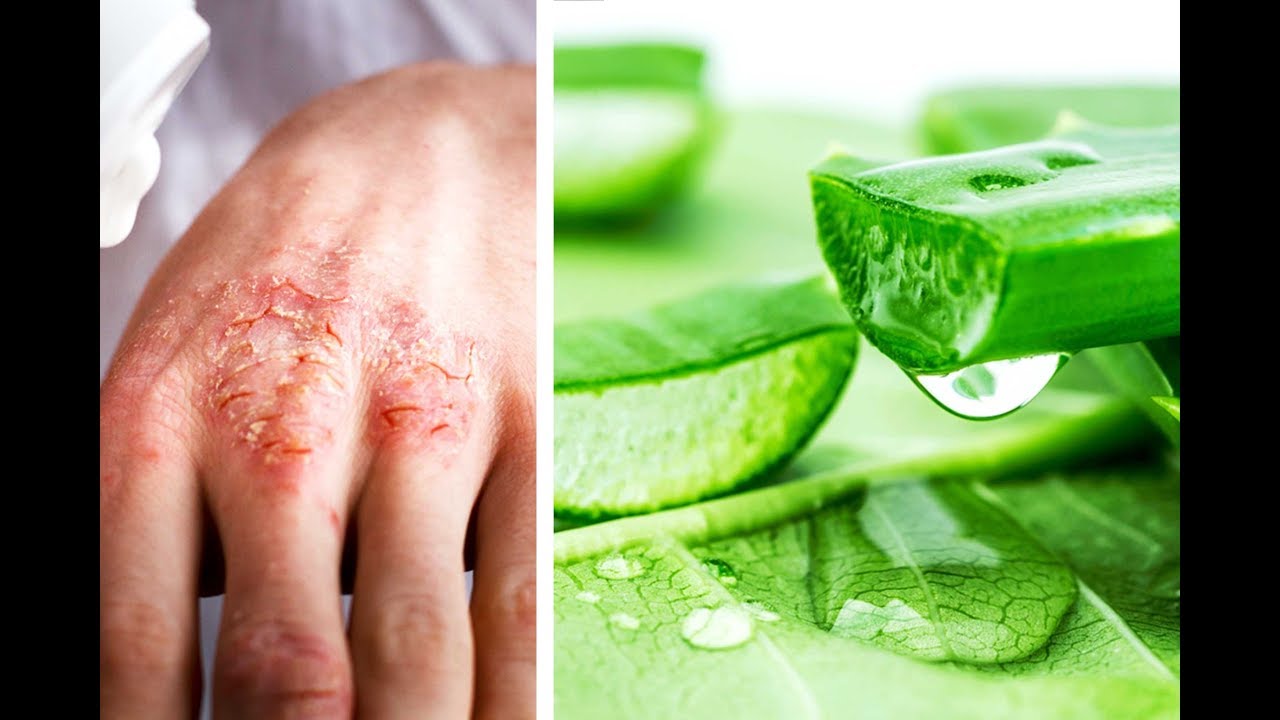 Le remède miracle contre l’eczéma existe, et il est d’une... - YouTube