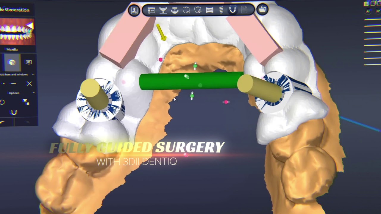 Bilateral Fully Guided Smile Design - YouTube