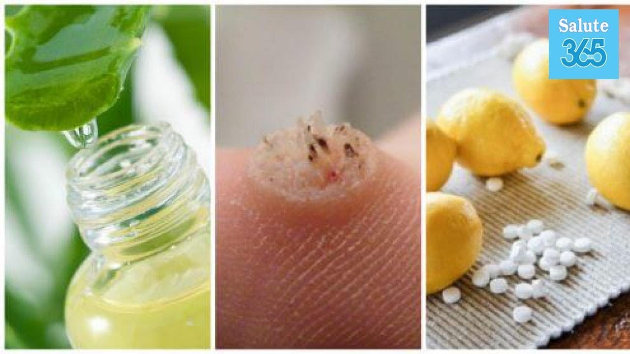 6 efficaci rimedi per eliminare le verruche - Salute 365 - YouTube