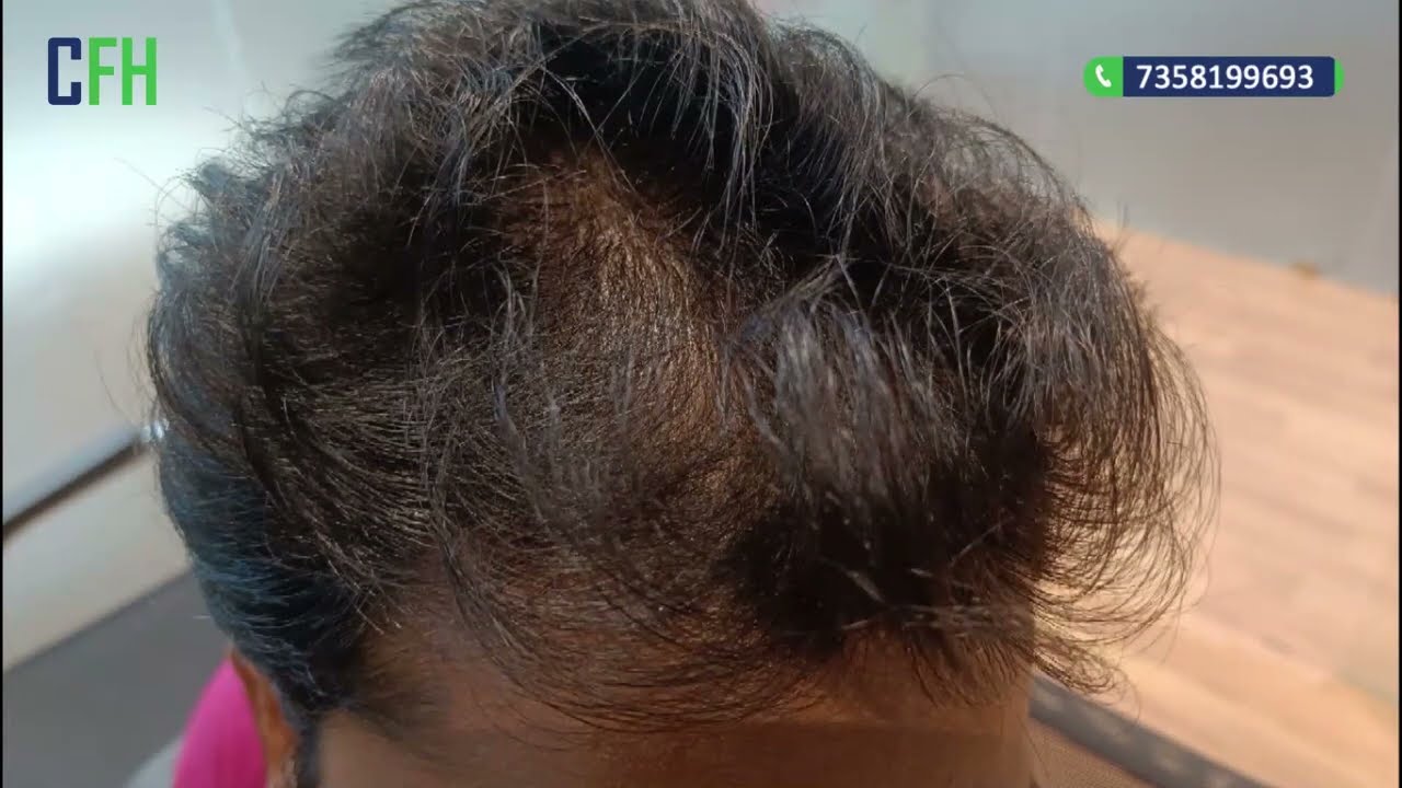 Before and After GFC Patient review| CFH Hairtranplant - YouTube
