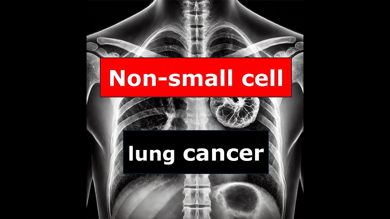 Non–Small Cell Lung Cancer for USMLE #usmle #usmlestep1 - YouTube