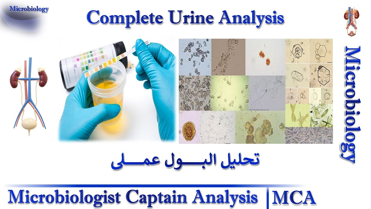 ادق طريقة لتحليل البول عملى + صور من تحت الميكرسكوب Complete Urine Analysis - YouTube