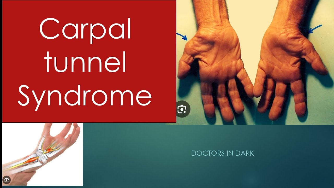 Carpal Tunnel Syndrome (CTS) | Upper Limb in 7 Days | Forearm and Hand ...