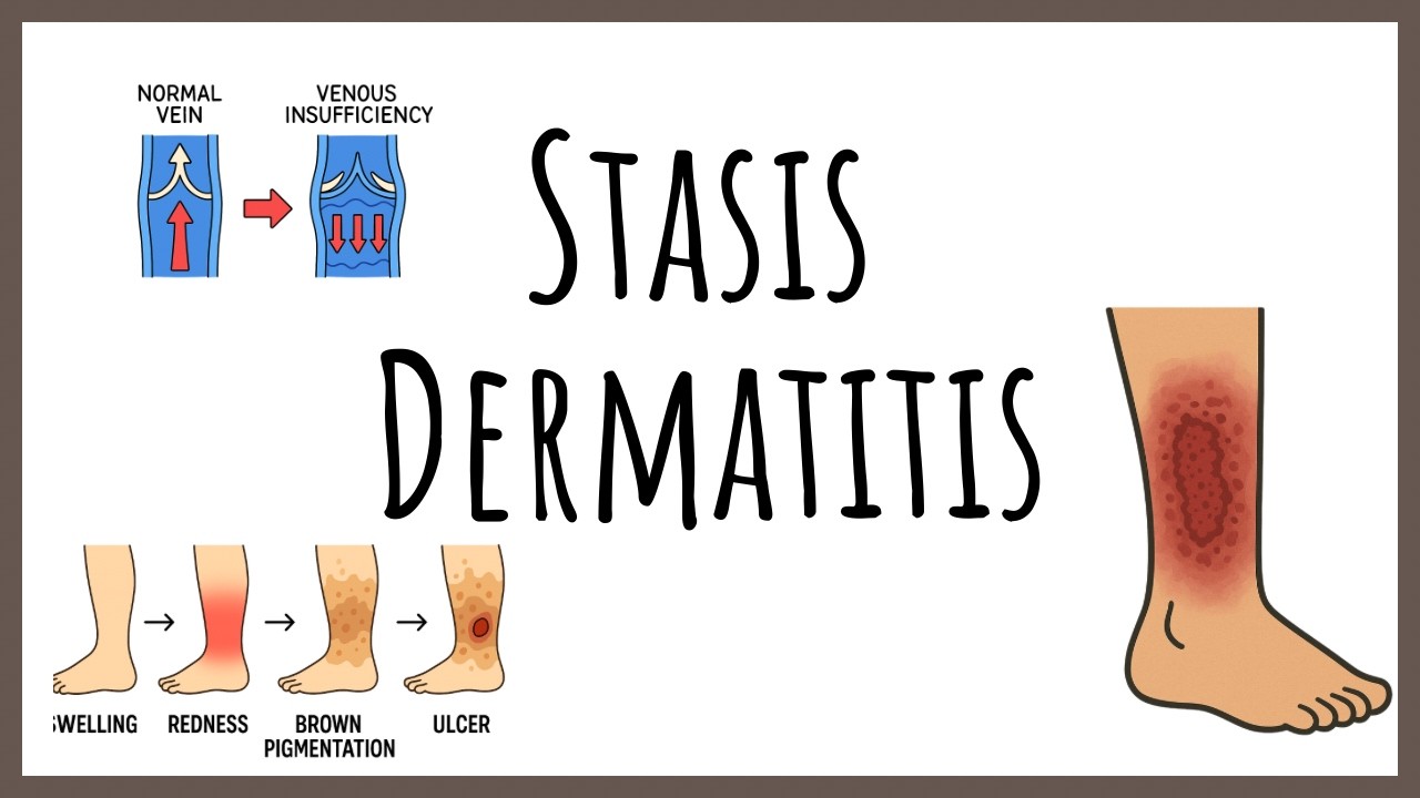 Stasis Dermatitis Made Simple | Causes, Symptoms & Treatment Explained ...