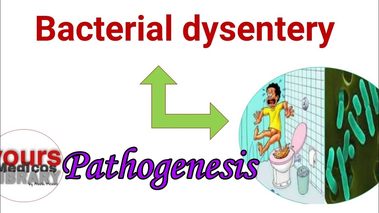 Pathogenesis Of Bacterial Dysentery Pathology In Hindi YouTube pathogenesis-of-bacterial-dysentery-pathology-in-hindi-youtube