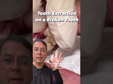 Can Dentist Remove Tooth Broken Off At Gum Line