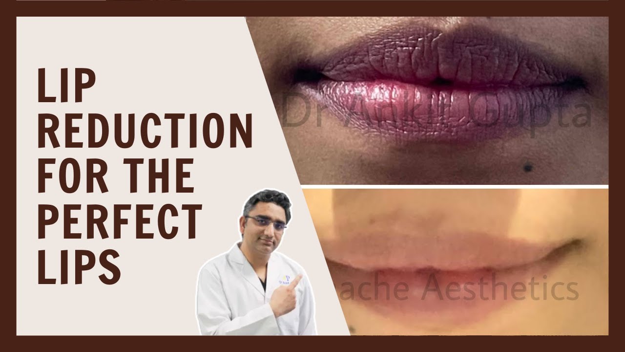 Lip Reduction – Reduce the Size of Your Lips in 1 Hour | Lip Reduction ...