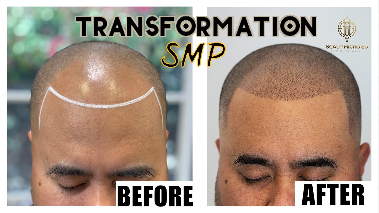 SMP TRANSFORMATION - Full Procedure Start to Finish | LIFE CHANGING ...