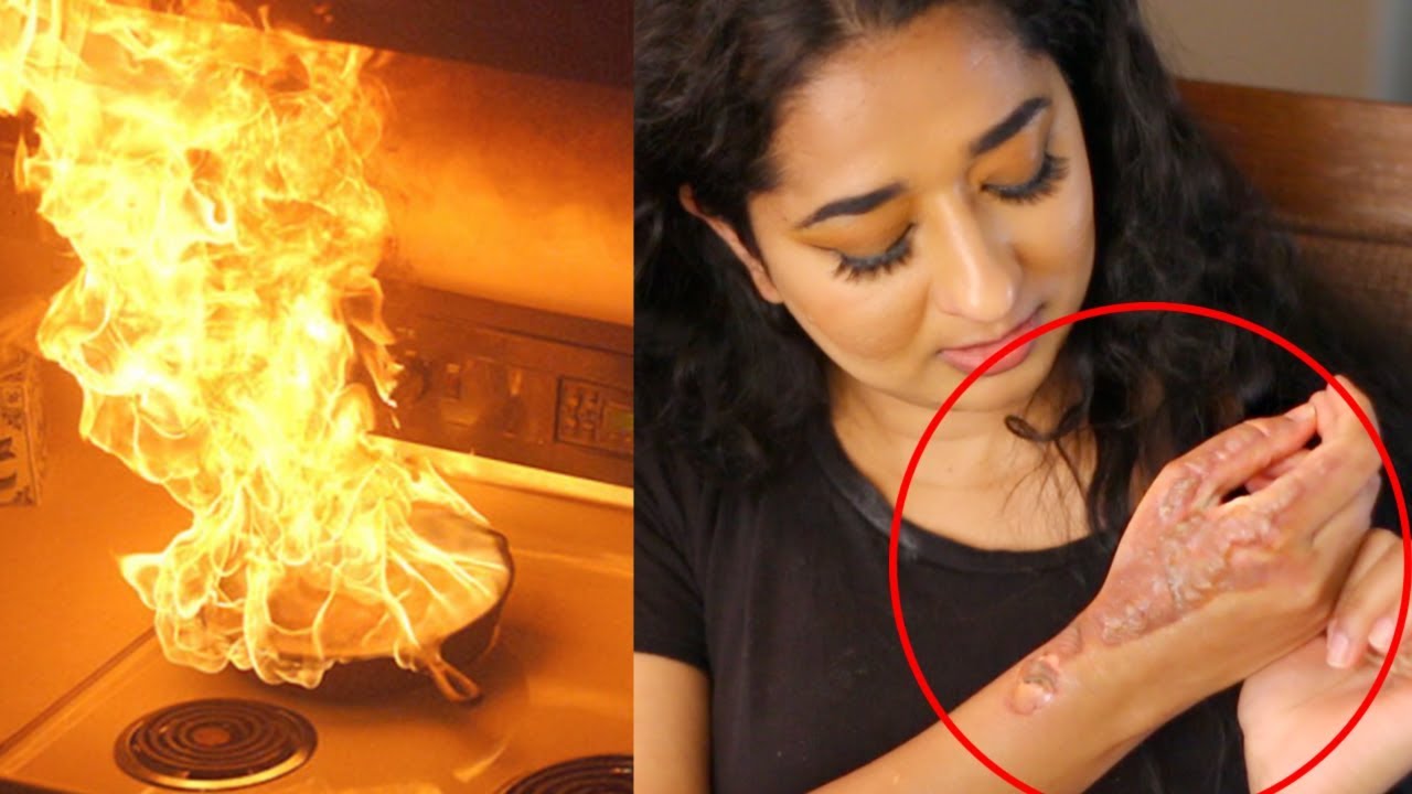 I Burned Myself WARNING GRAPHIC CONTENT YouTube i-burned-myself-warning-graphic-content-youtube