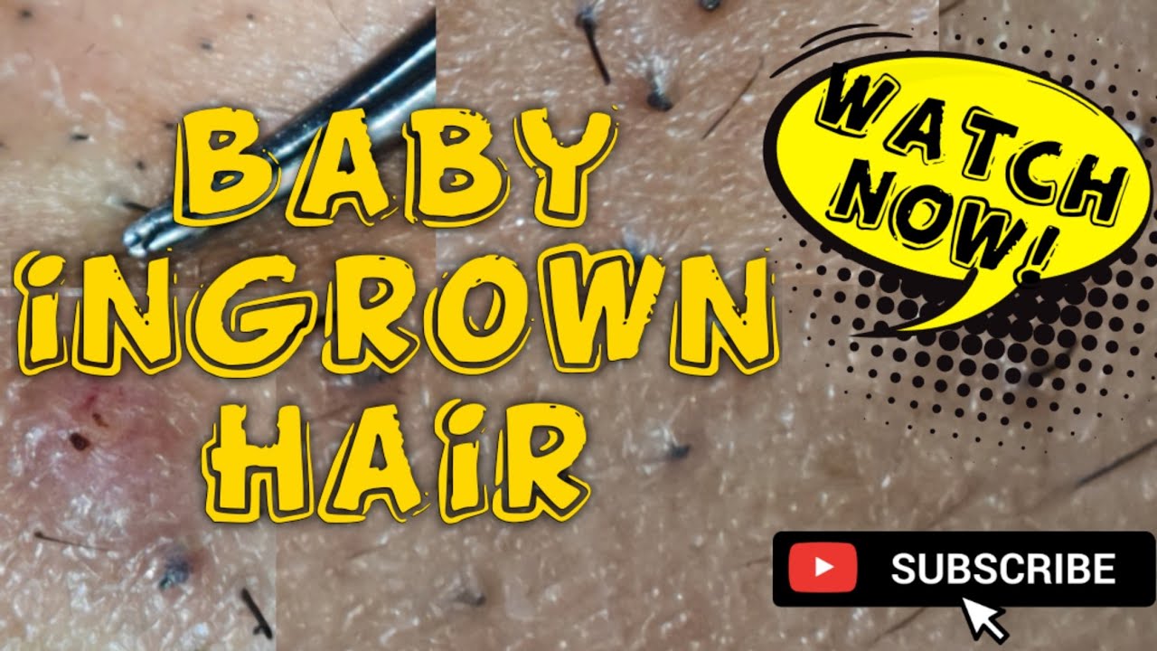 Small ingrown hair removal - YouTube