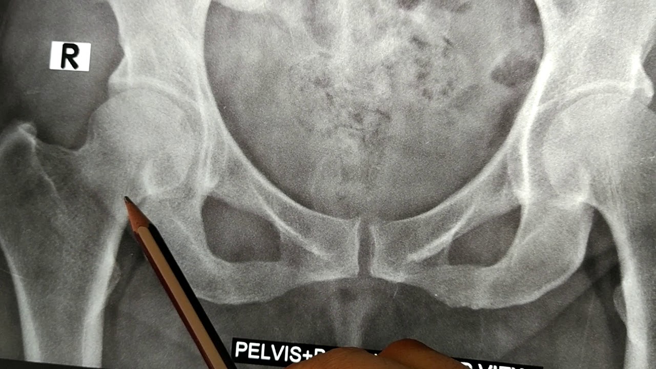 X ray pelvis, anatomy with clinical correlation - YouTube