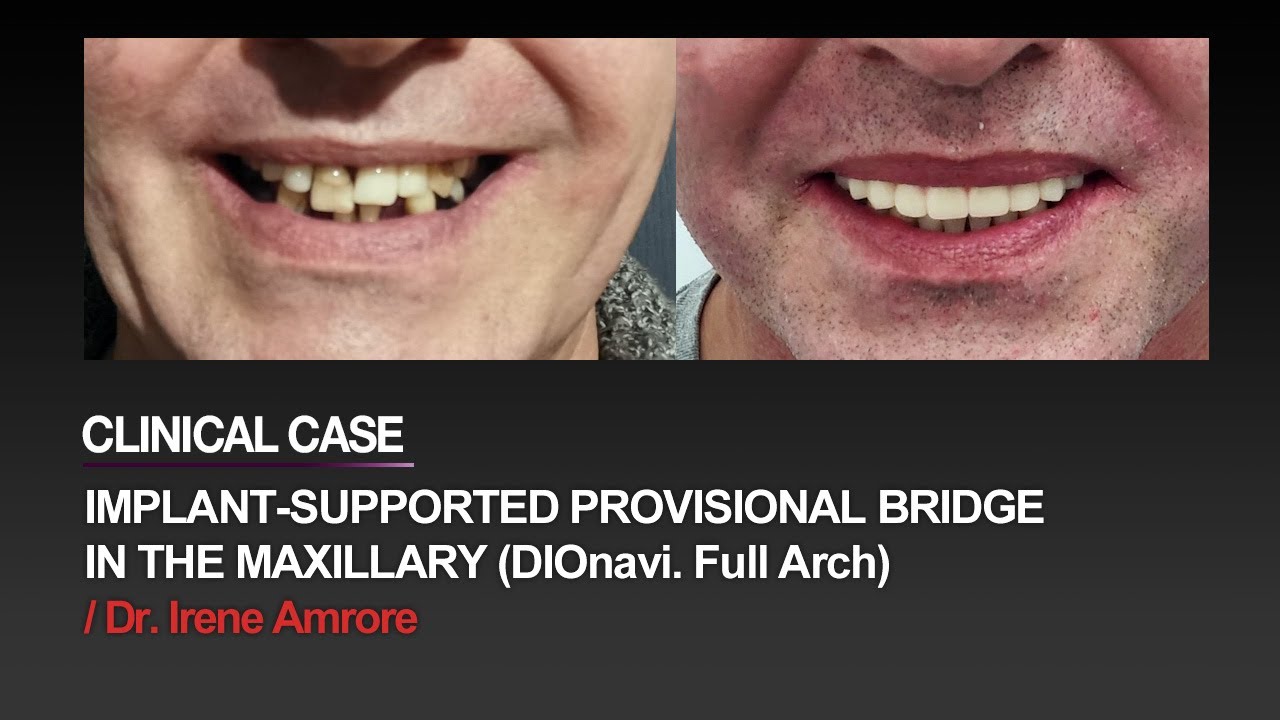 Implant-supported Immediate Restoration with DIOnavi. FullArch - YouTube