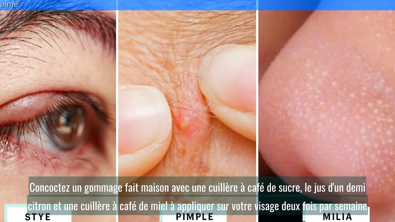 Il est possible de faire disparaître les grains de milium en adoptant ...