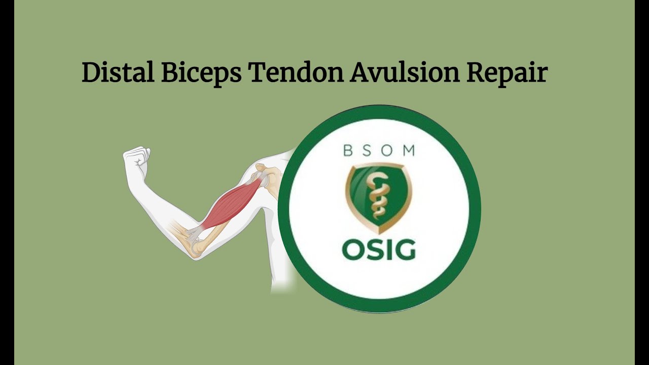 Distal Biceps Tendon Avulsion Repair: The Basics - YouTube