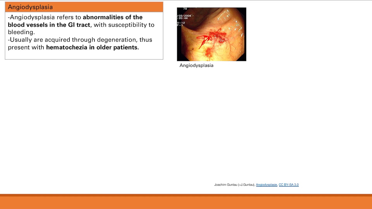 More Intestinal Pathology | GI system | Step 1 Simplified - YouTube