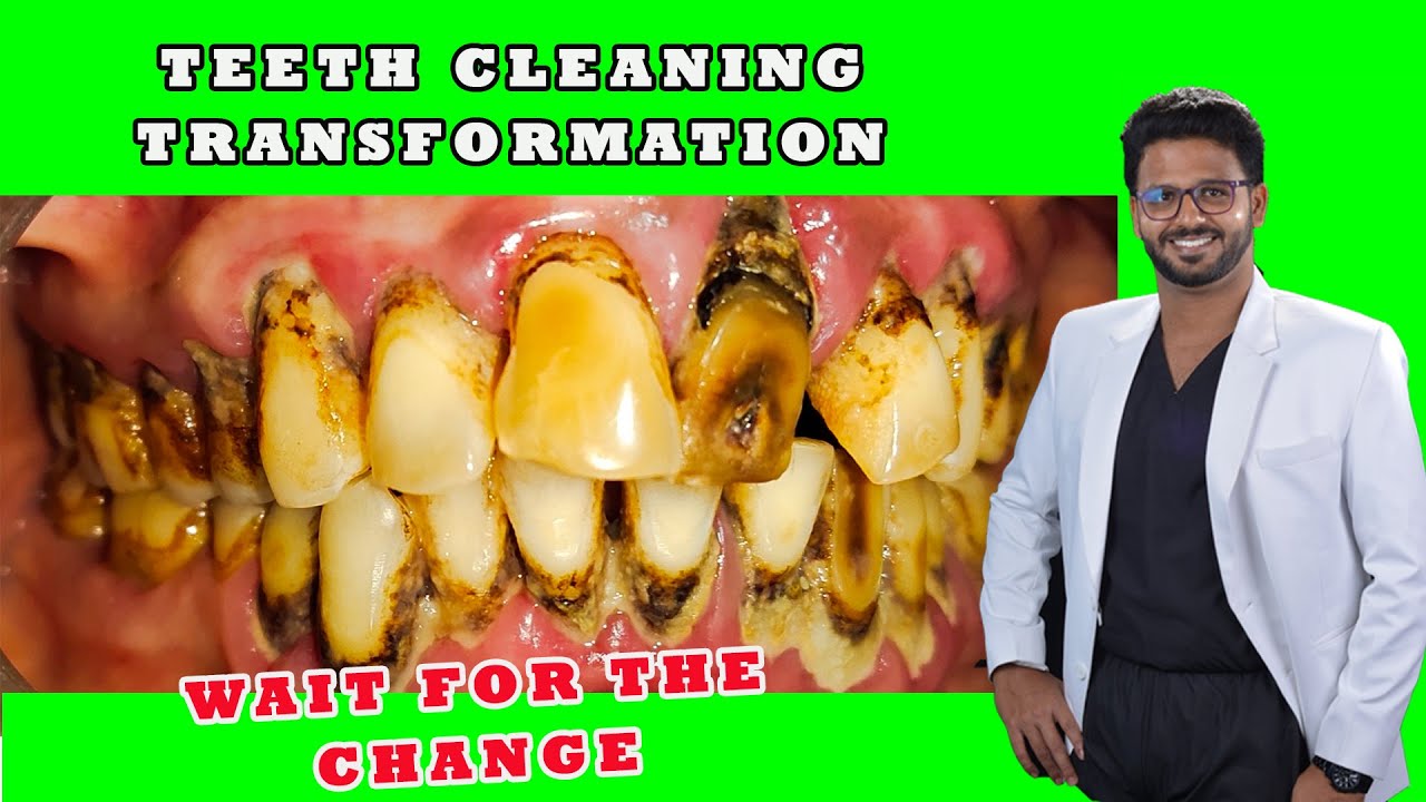 𝐀𝐌𝐀𝐙𝐈𝐍𝐆 𝐓𝐄𝐄𝐓𝐇 𝐂𝐋𝐄𝐀𝐍𝐈𝐍𝐆 𝐓𝐑𝐀𝐍𝐒𝐅𝐎𝐑𝐌𝐀𝐓𝐈𝐎𝐍!!! - YouTube