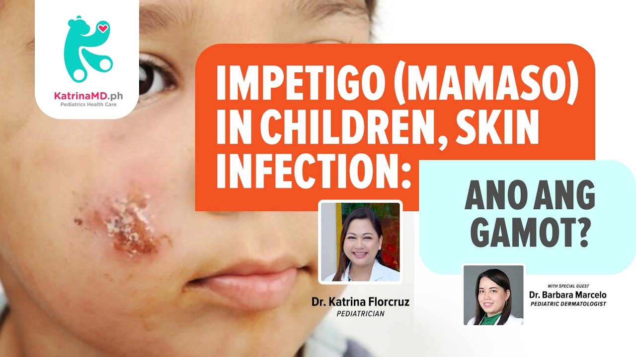 Impetigo (Mamaso) in Children, Skin Infection – Ano ang Gamot? - YouTube