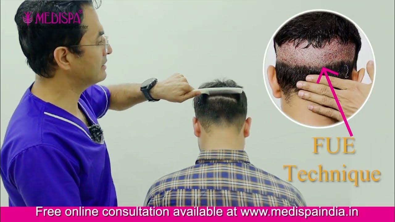 2500 Grafts Hair Transplant Results Grade 3 Dr Suneet Soni At Medispa
