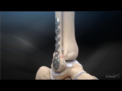 How Do Locking Screws Work Orthopedics