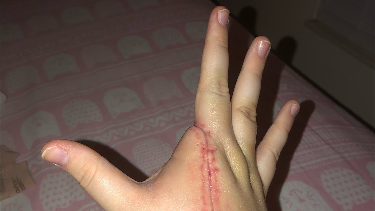 Storytime- Why I’m Missing a Finger - YouTube