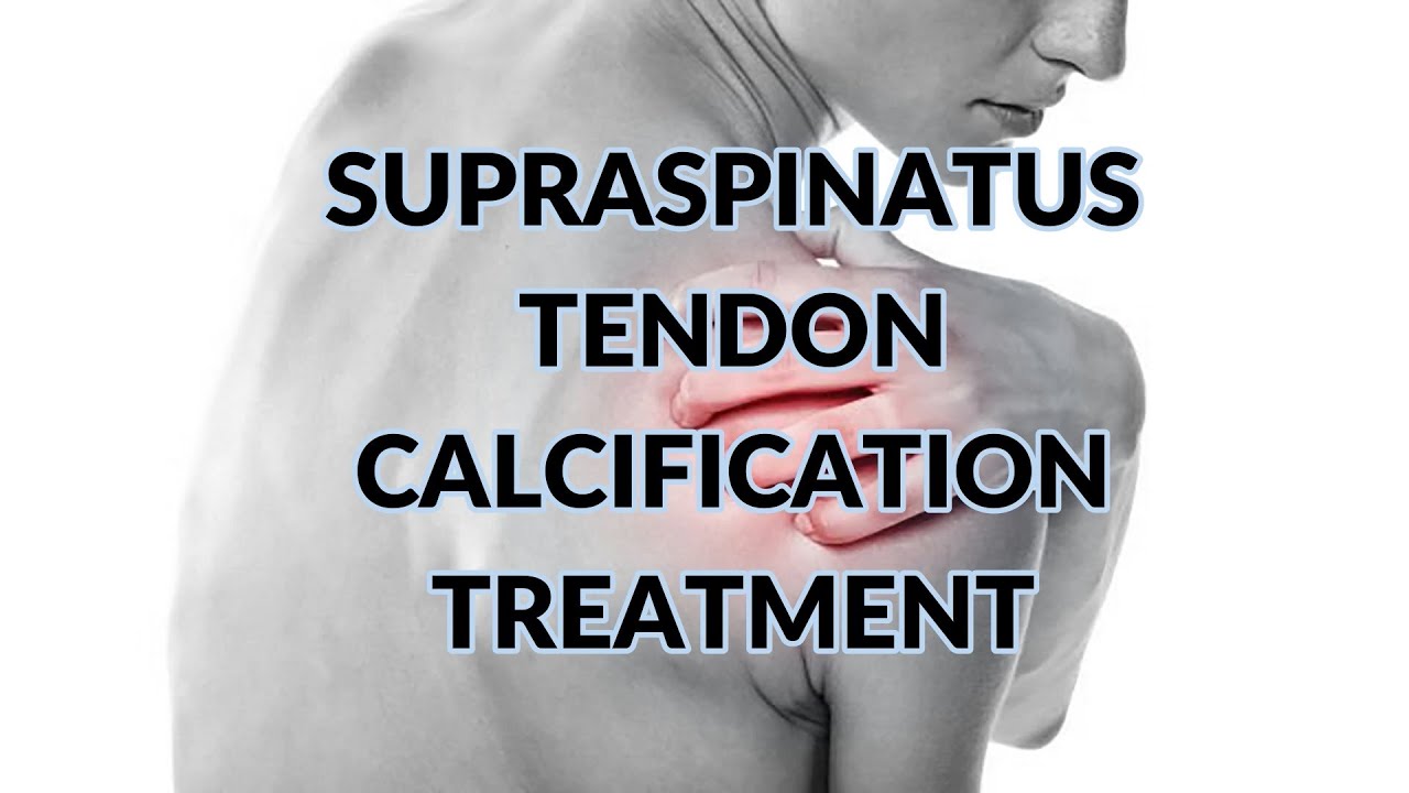 ShockWave Dual Power - Calcification Supraspinatus Tendon - YouTube
