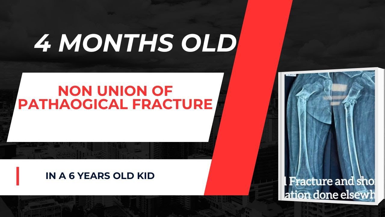 4 MONTHS OLD NON UNION OF PATHOLOGICAL FRACTURE IN A 6 YR OLD KID ...