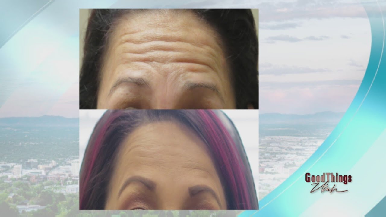 Utah Facial Plastics: Botox Cosmetic Day - YouTube