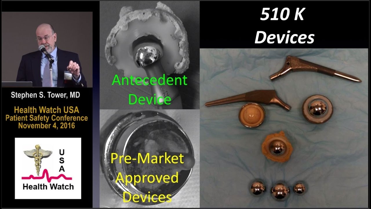 Complications of Wear or Corrosion of Chrome-Cobalt Hip Implants - YouTube