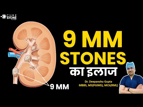 9 mm Kidney Stone Treatment (in Hindi) | Say Goodbye to Kidney Stone #kidneystone