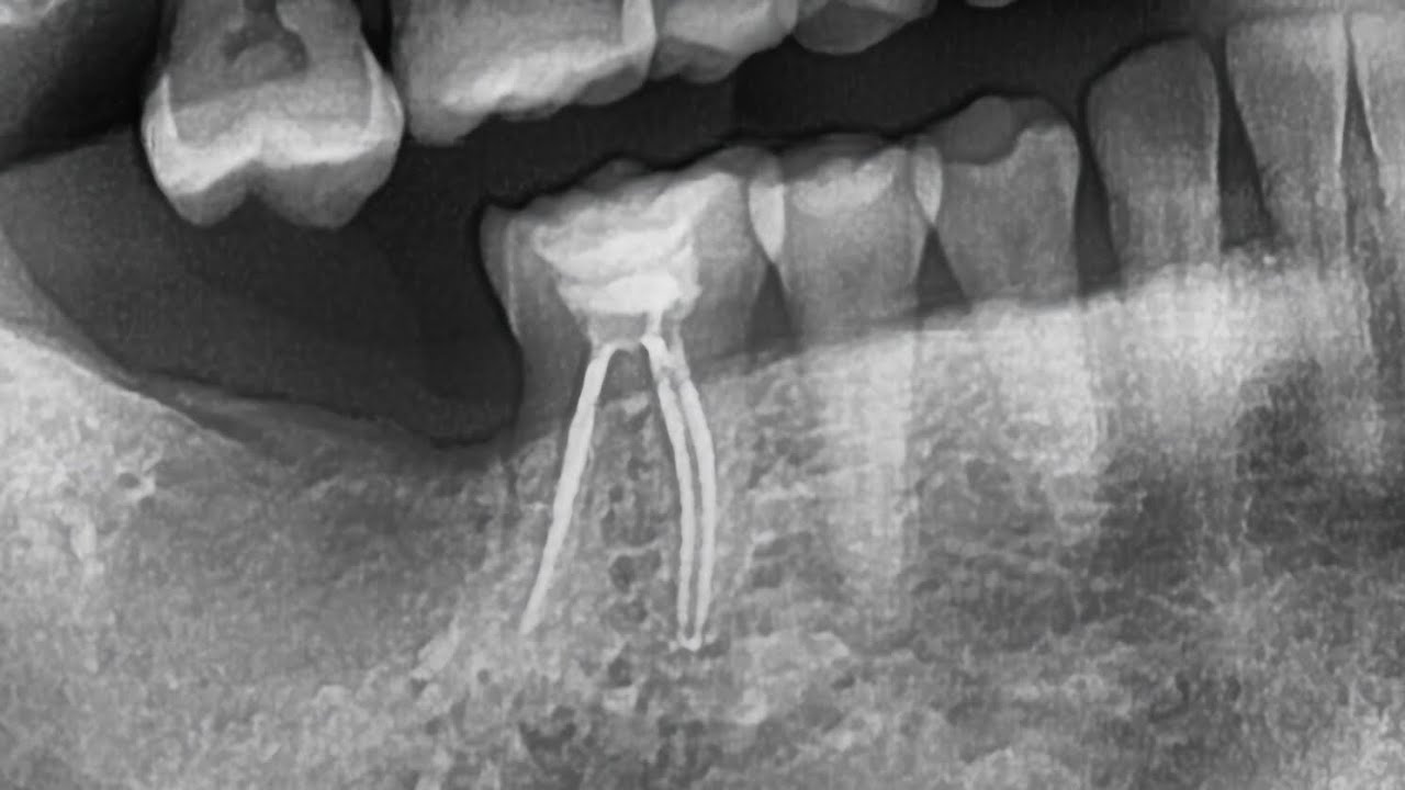 Single visit Root canal treatment on a lower first molar - YouTube