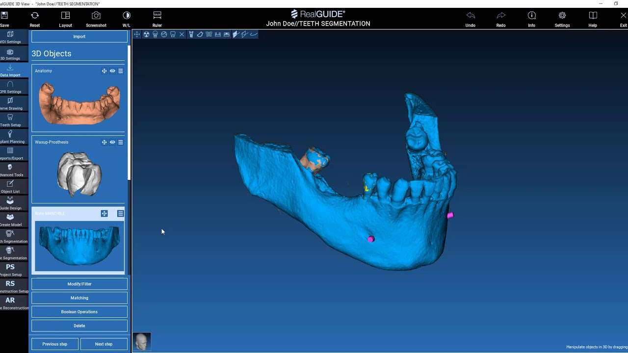AI-supported teeth segmentation - YouTube
