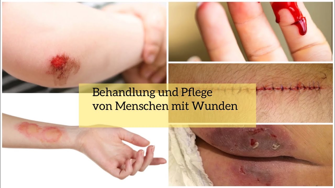 Hören B1B2 Pflege: Behandlung und Pflege von Menschen mit Wunden - YouTube