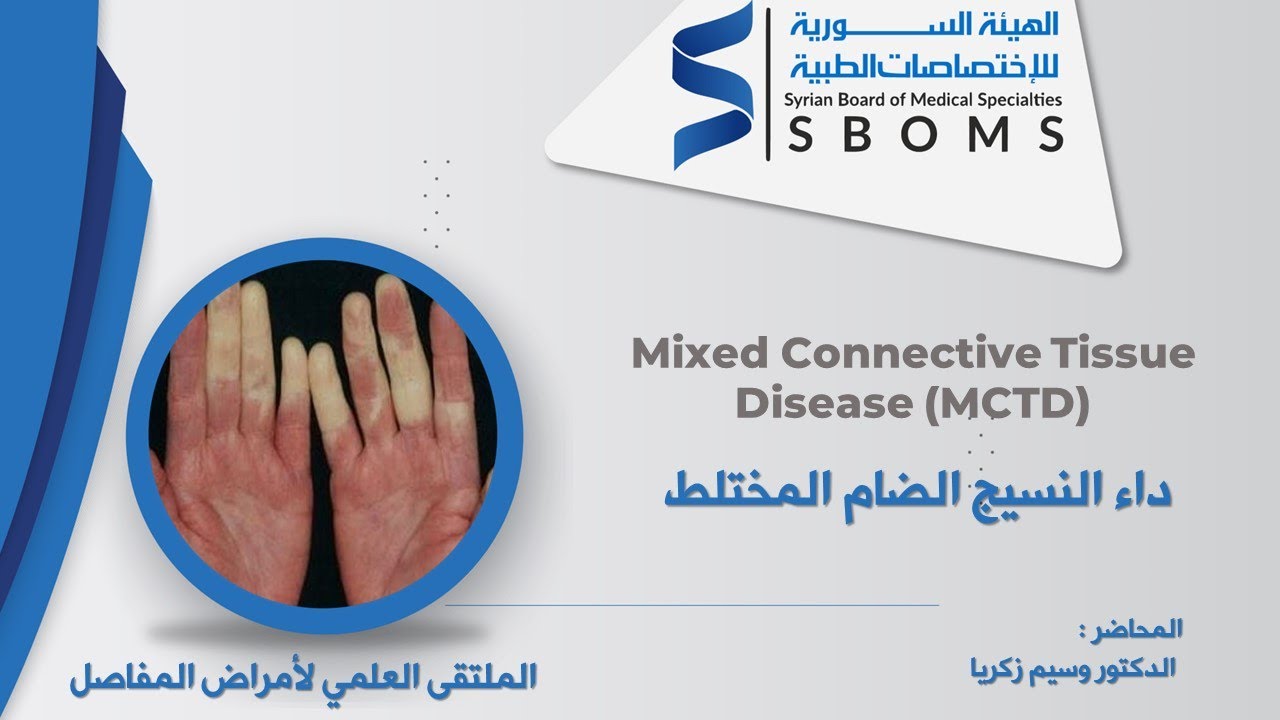 داء النسيج الضام المختلط _ Mixed Connective Tissue Disease (MCTD) - YouTube