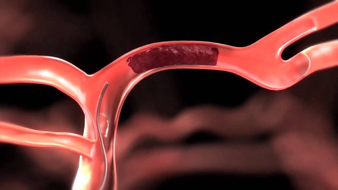 Stroke: Acute Stroke Intervention - YouTube