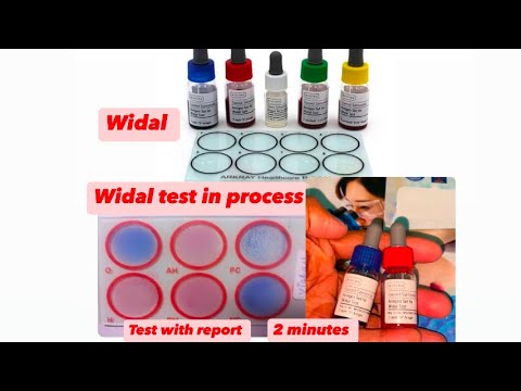 Widal test procedure kaise kare Complete procedure in hindilWIDAL test ...