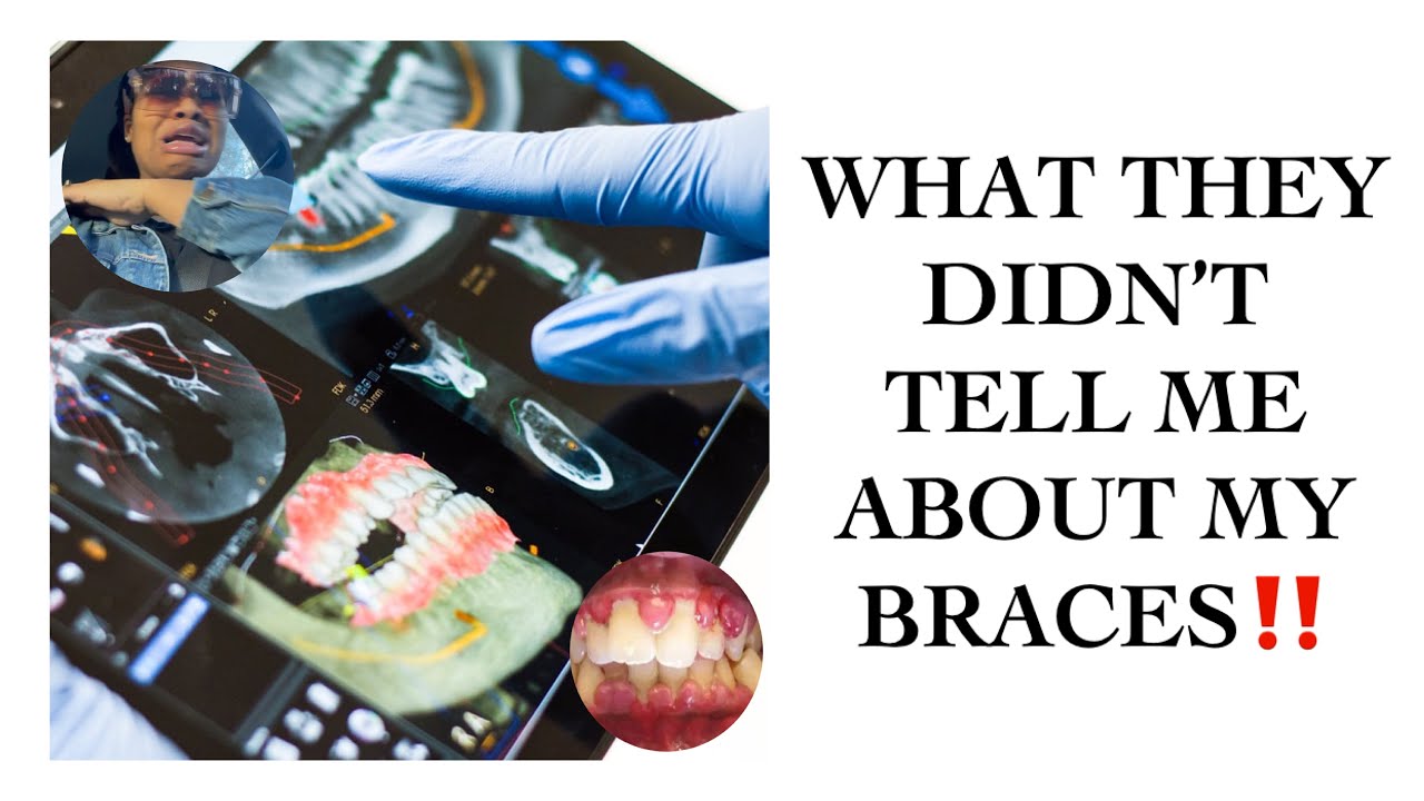BRACES HORROR STORY | I REGRET MY BRACES? - YouTube