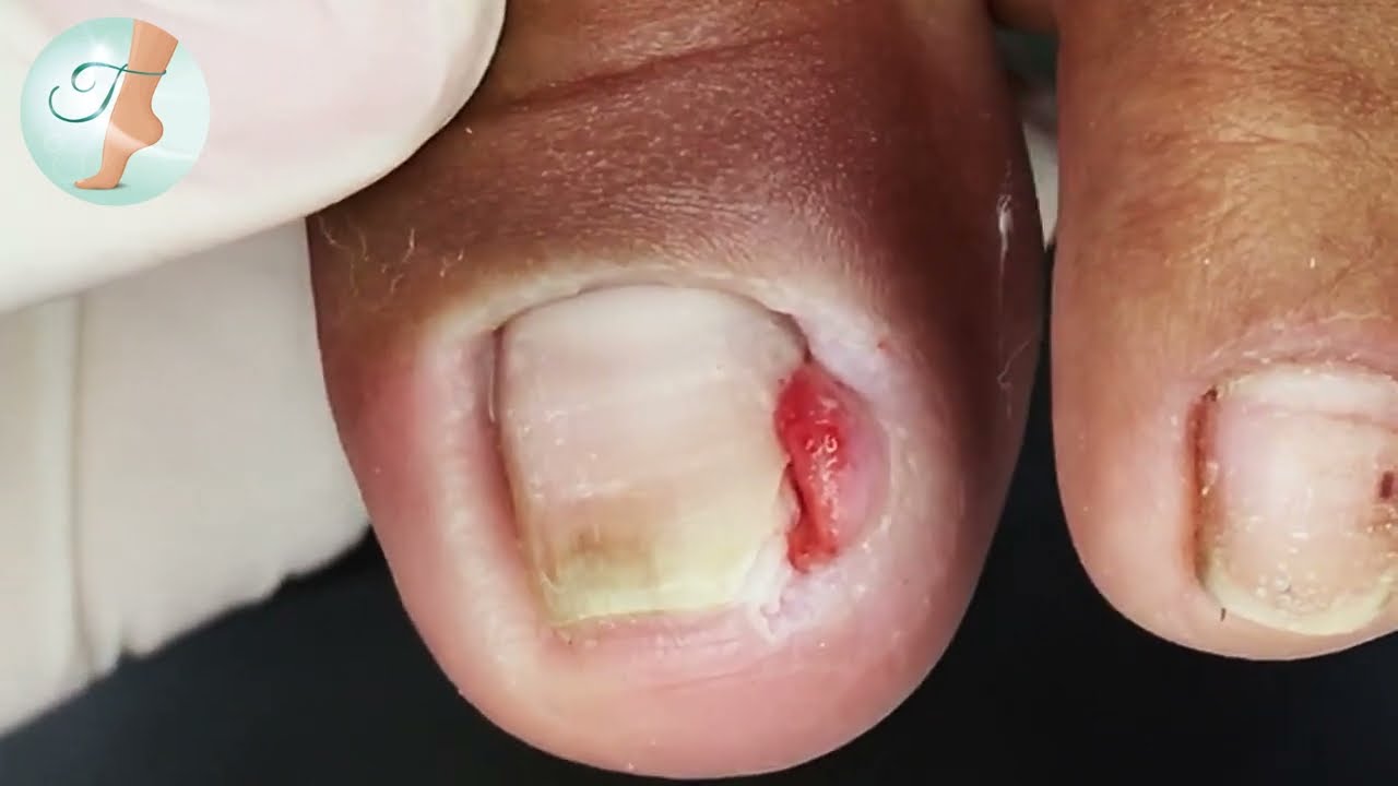 Granuloma Na Unha Tratamento Caseiro - RETOEDU