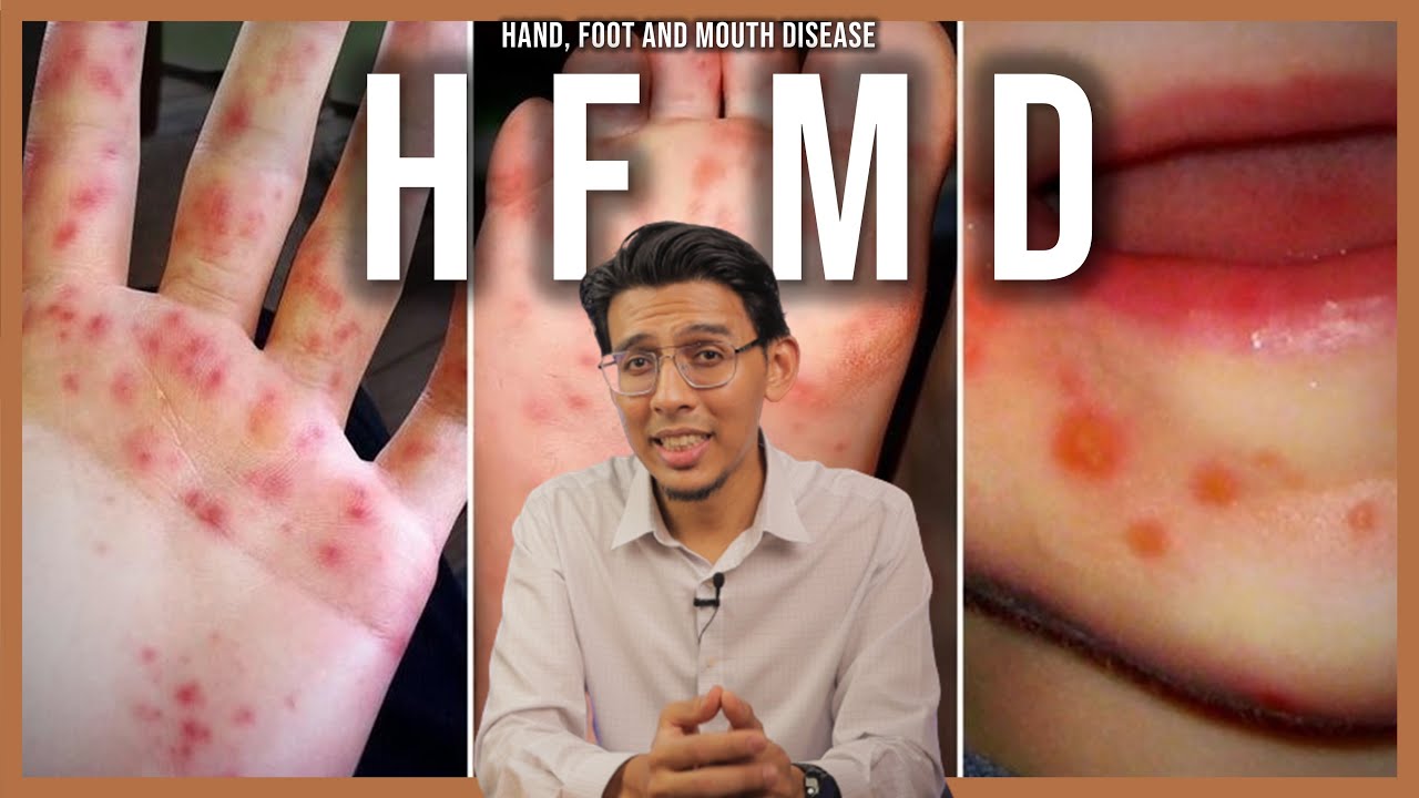 HFMD : Ketahui Tanda-tanda dan Langkah Pencegahan - YouTube