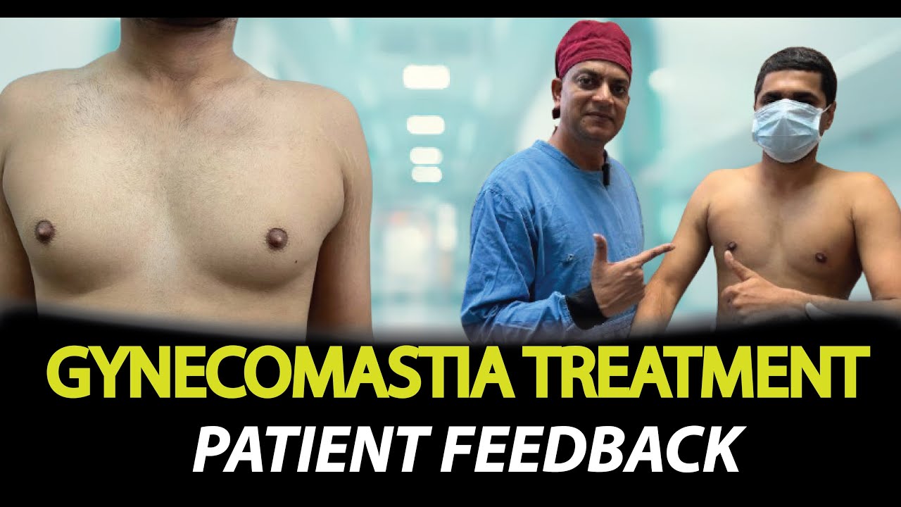 Gynecomastia Symptoms and Treatment | Before and After | Rejuvena Cosmo Care by Dr. Deepesh ...