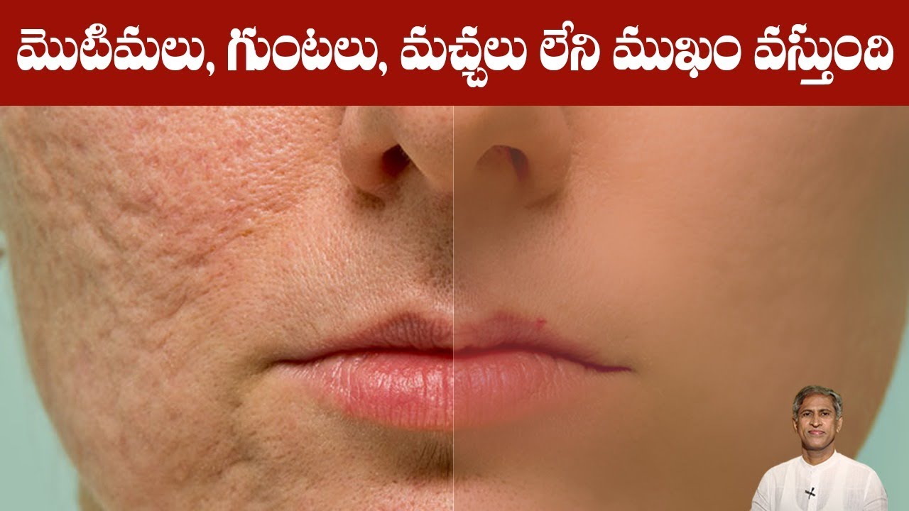 Tips to Remove Pimples and Acne Scars | Body Detoxification | Clear ...