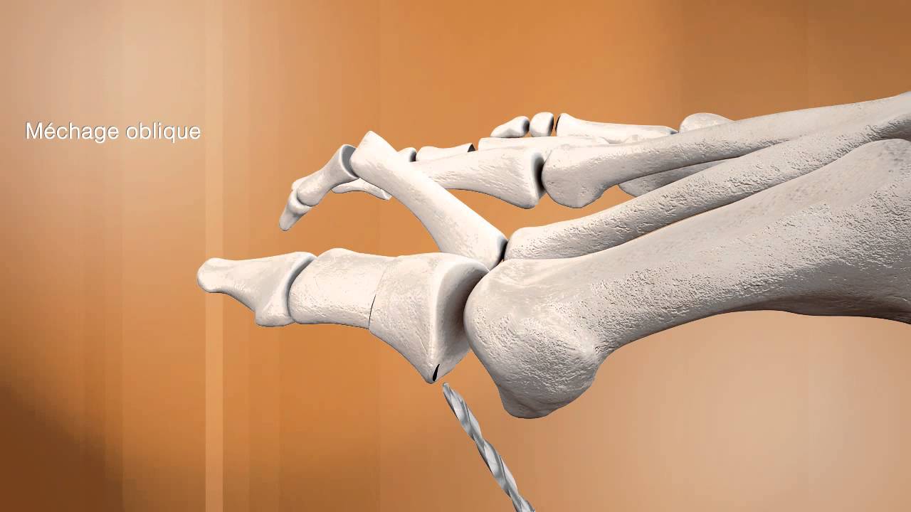 5 AKIN - L'ostéotomie de la 1ère phalange du gros orteil - Dr. Coillard ...