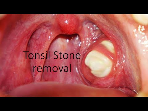 Huge tonsil stones! - Tonsil stone removal. - YouTube